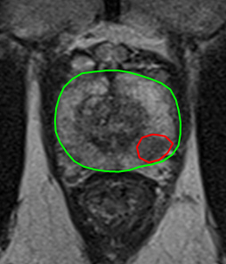 Prostate Biopsy | Partners Imaging Centers | Prostate Cancer Imaging ...